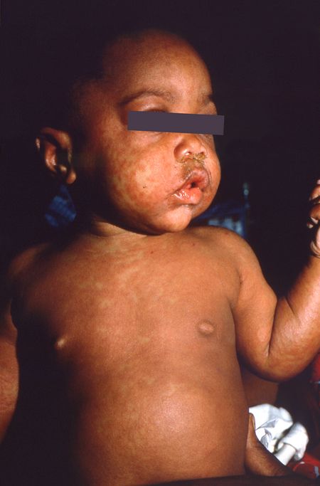 Rougeole | Gouvernement du Québec